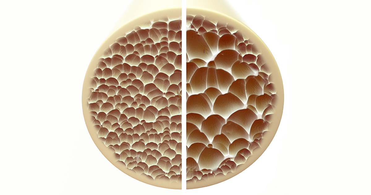 Will I continue to lose bone? - Your Path to Good Bone Health